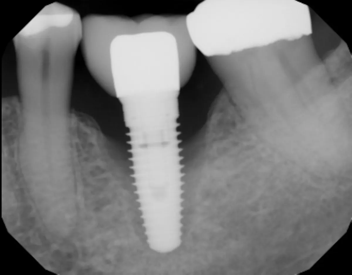 Replacement dental implants: 3 clinical methods to increase survival ...