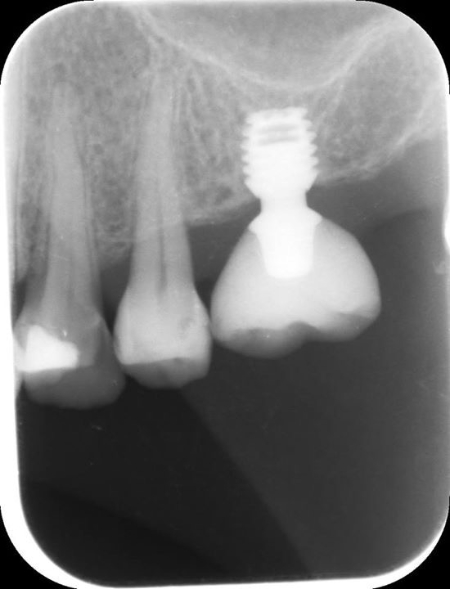 Short Implants Posterior Mandible