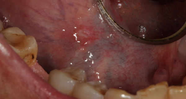 Pediatric Dentistry Aphthous Ulcers Canker Sores