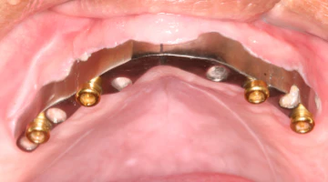 Implant Supported Dentures Maxillary
