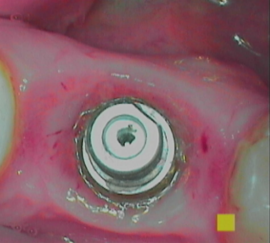 Clinical applications for the 2018 classification of peri-implant ...