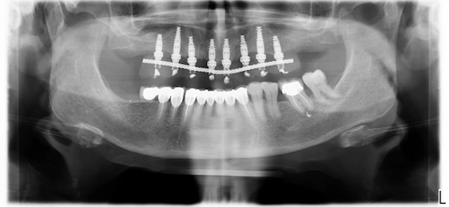 Are narrow implants a reliable solution? | Perio-Implant Advisory