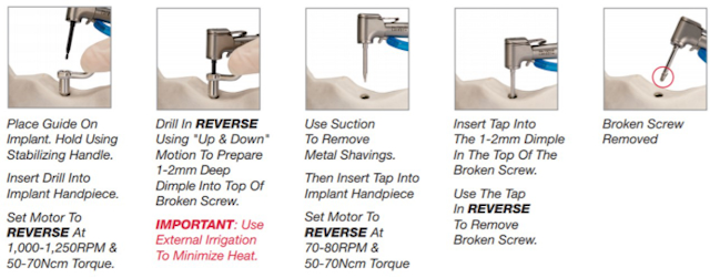 Fractured dental implant screw complications: 3 methods for screw ...