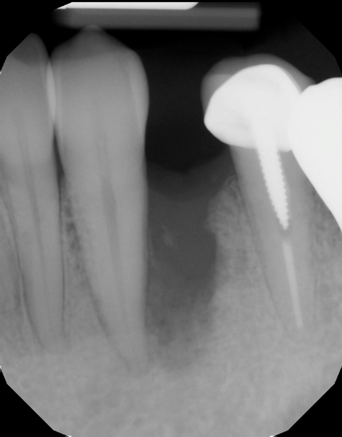 Bone grafting after tooth removal: Why, when, and what to use | Perio ...
