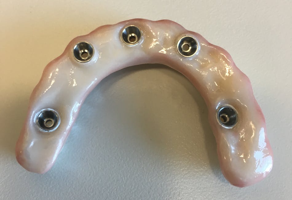 Maintaining full-arch dental implant prosthetics | Perio Implant Advisory