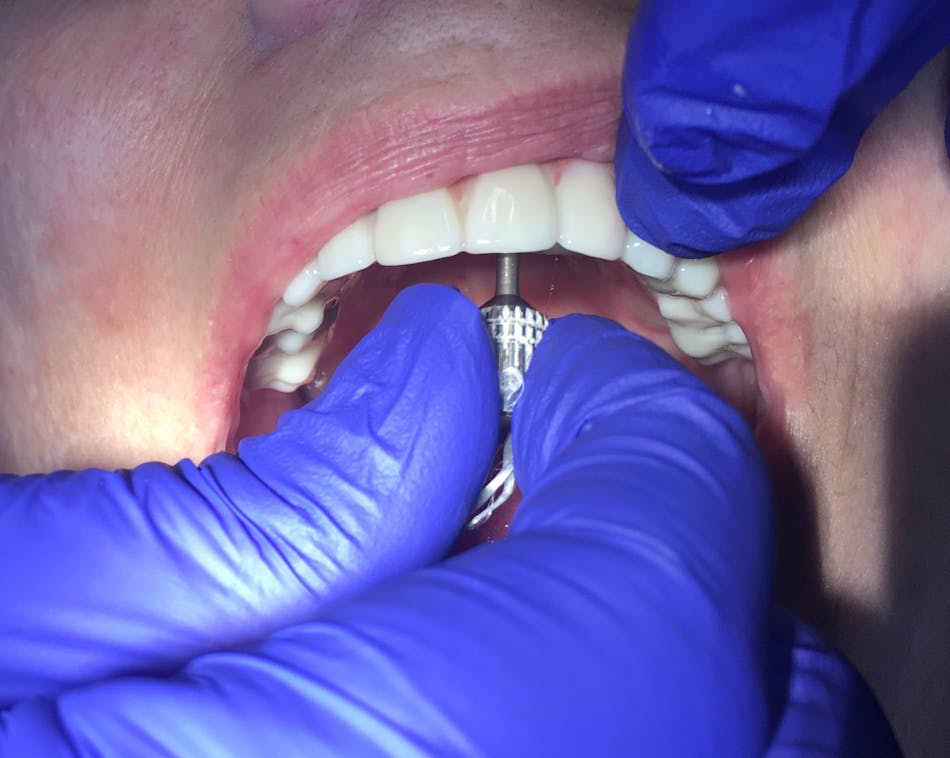 Maintaining full-arch dental implant prosthetics | Perio Implant Advisory