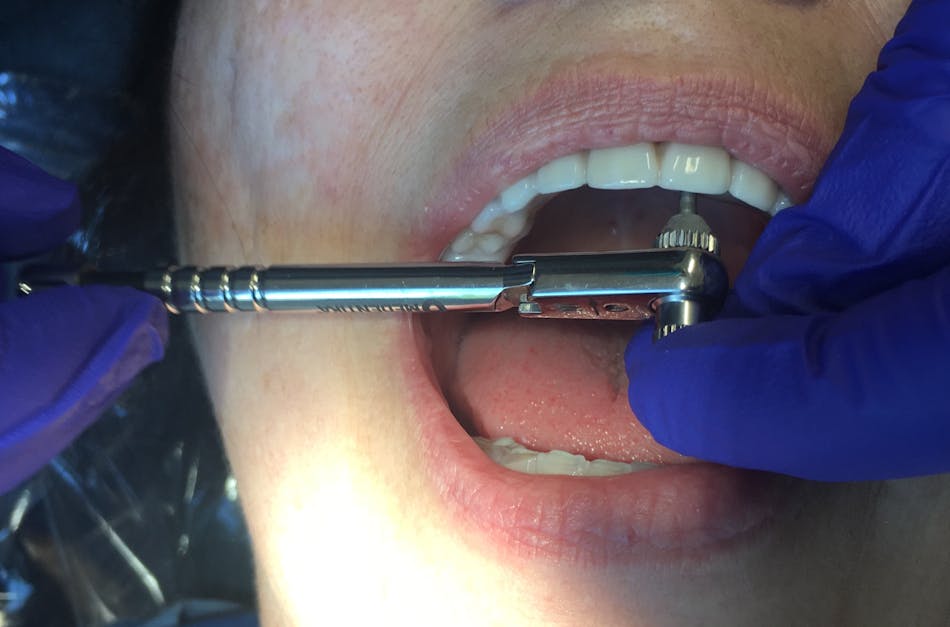 Maintaining full-arch dental implant prosthetics | Perio Implant Advisory