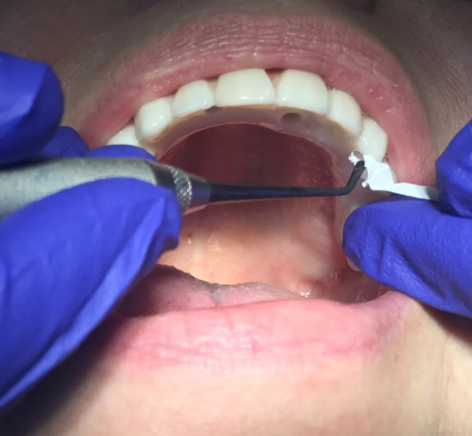 Maintaining full-arch dental implant prosthetics | Perio Implant Advisory