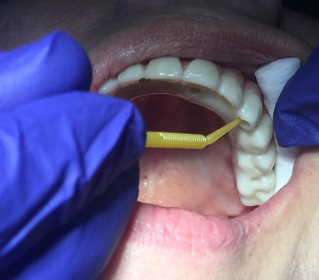 Maintaining full-arch dental implant prosthetics | Perio Implant Advisory