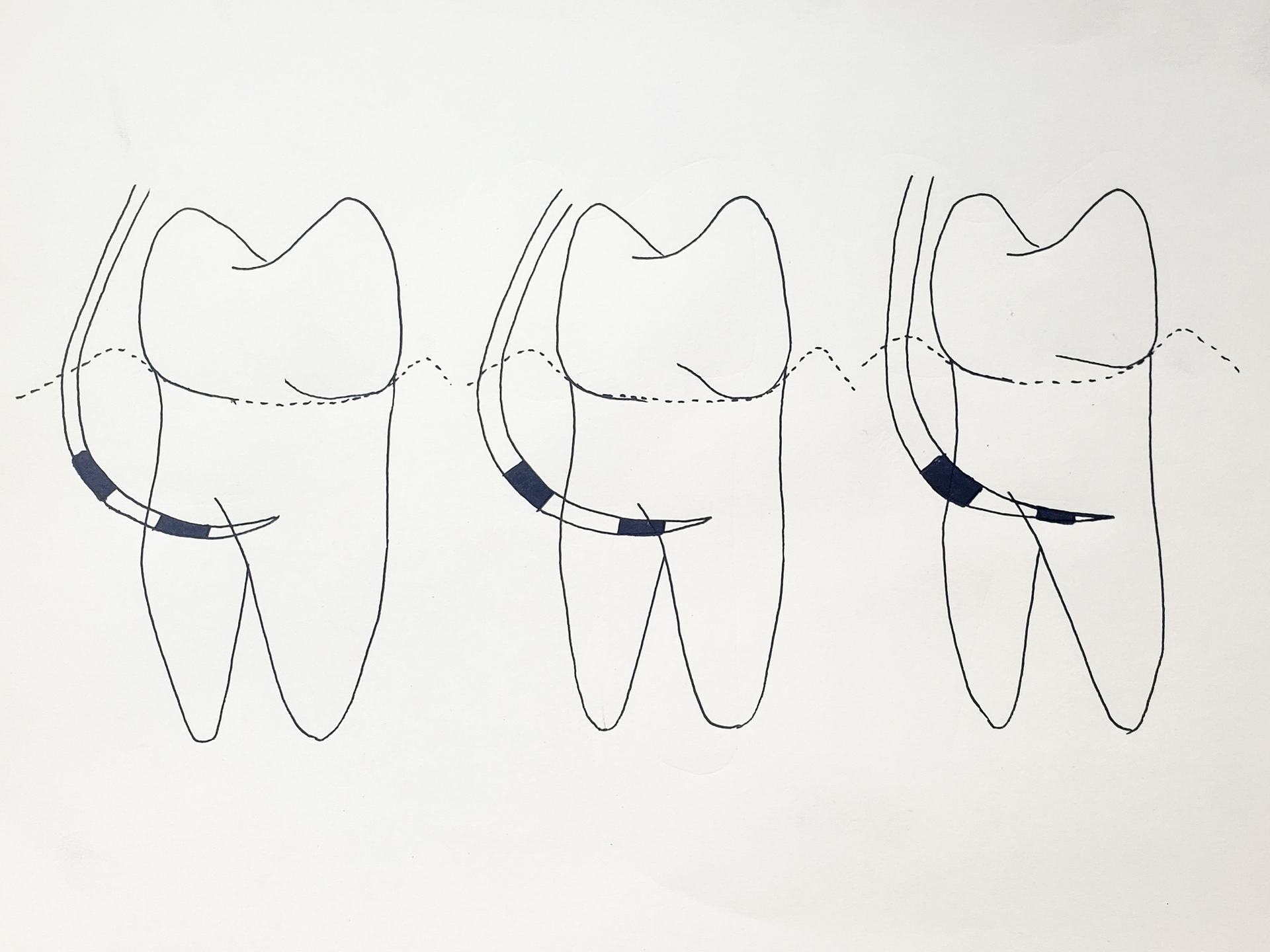 Saving teeth: Revisiting molar furcation treatment with advanced ...