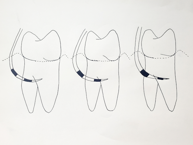 Saving teeth: Revisiting molar furcation treatment with advanced ...