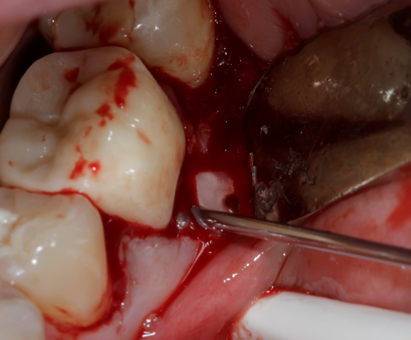 Saving teeth: Revisiting molar furcation treatment with advanced ...