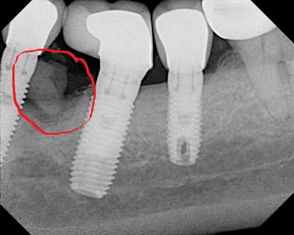 Dental implant contamination: 3 reasons behind a late-stage failure ...