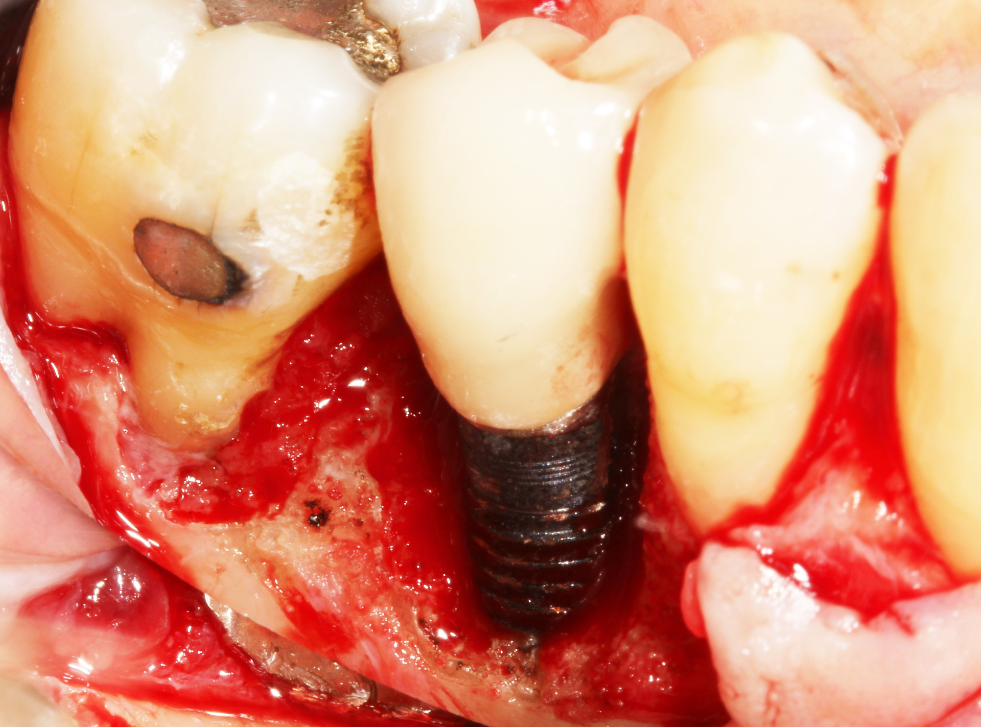 Dental implant failure: 3 common medical conditions that may affect ...