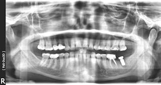 Bone augmentation: Failures and complications | Perio Implant Advisory