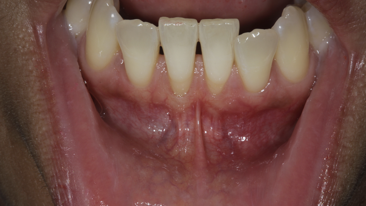 Importance of soft tissue around teeth and dental implants | Perio ...