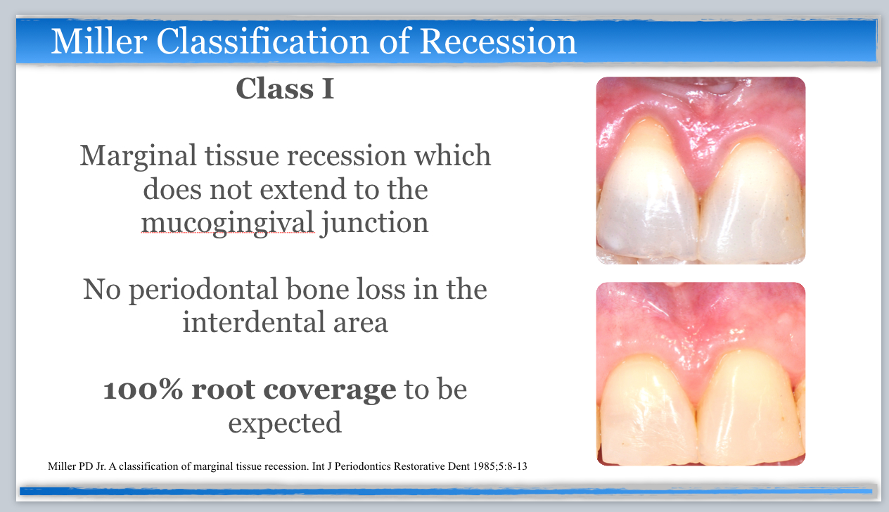 Importance of soft tissue around teeth and dental implants | Perio ...