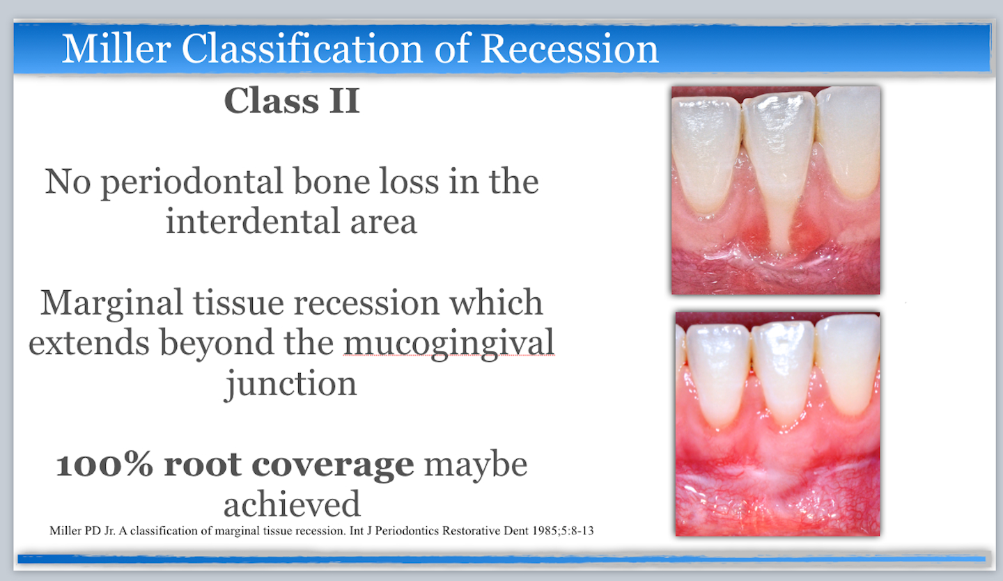 Importance of soft tissue around teeth and dental implants | Perio ...