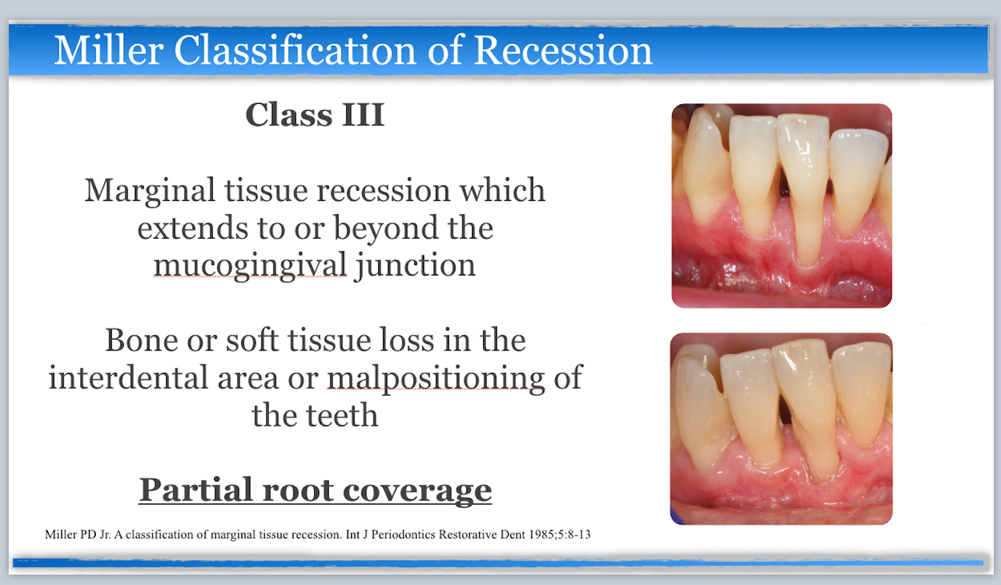 Importance of soft tissue around teeth and dental implants | Perio ...