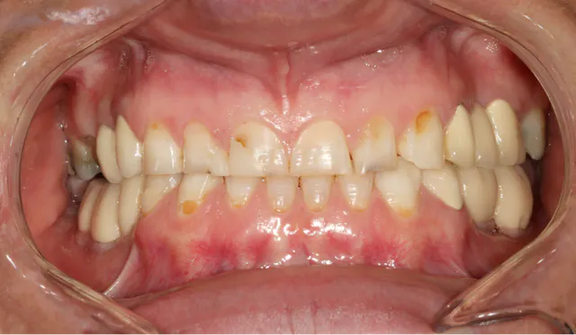 Sjögren's syndrome: Considerations during and after cosmetic dentistry ...