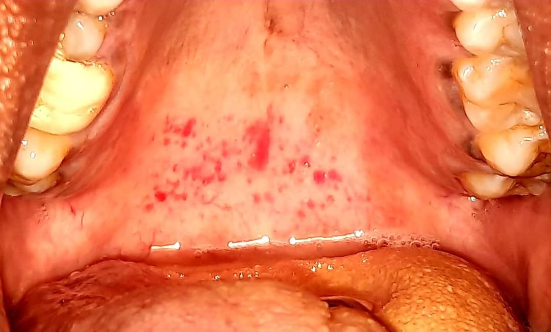 Oral Manifestations In COVID 19 positive Patients 8 Case Reports oral-manifestations-in-covid-19-positive-patients-8-case-reports