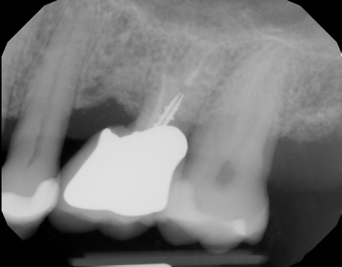 Avoiding dental implants and the sinus lift procedure: Revisiting ...