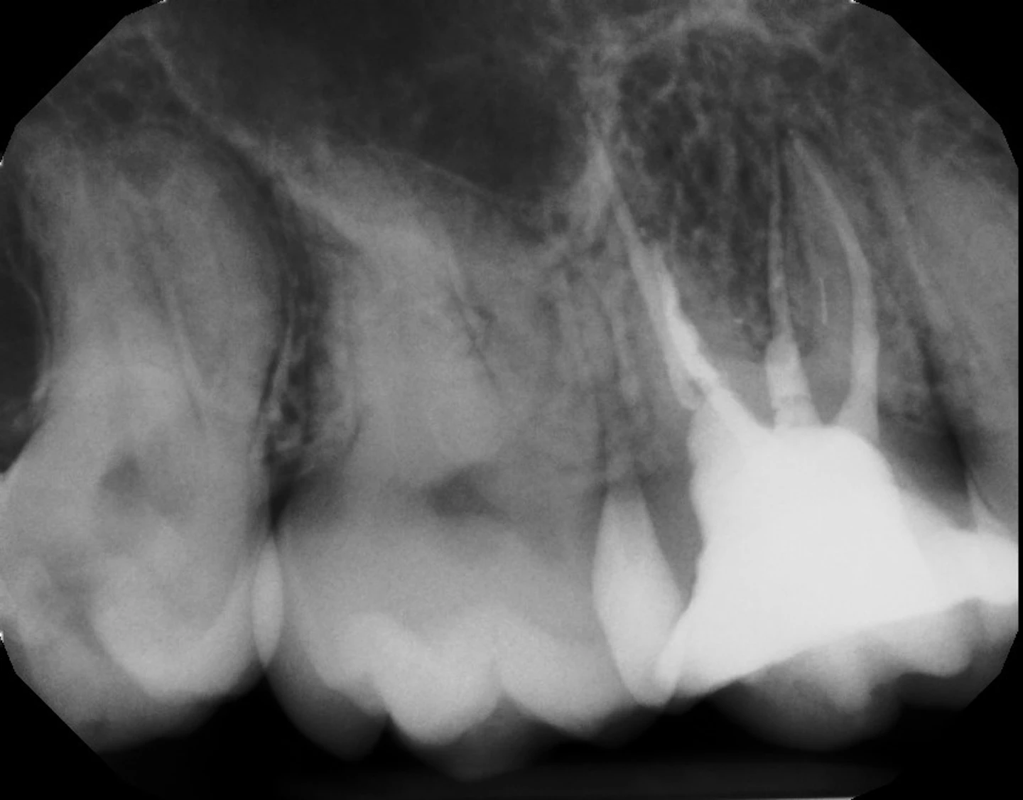 Avoiding dental implants and the sinus lift procedure: Revisiting ...