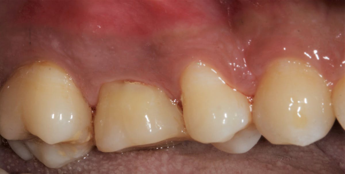 Avoiding dental implants and the sinus lift procedure: Revisiting ...