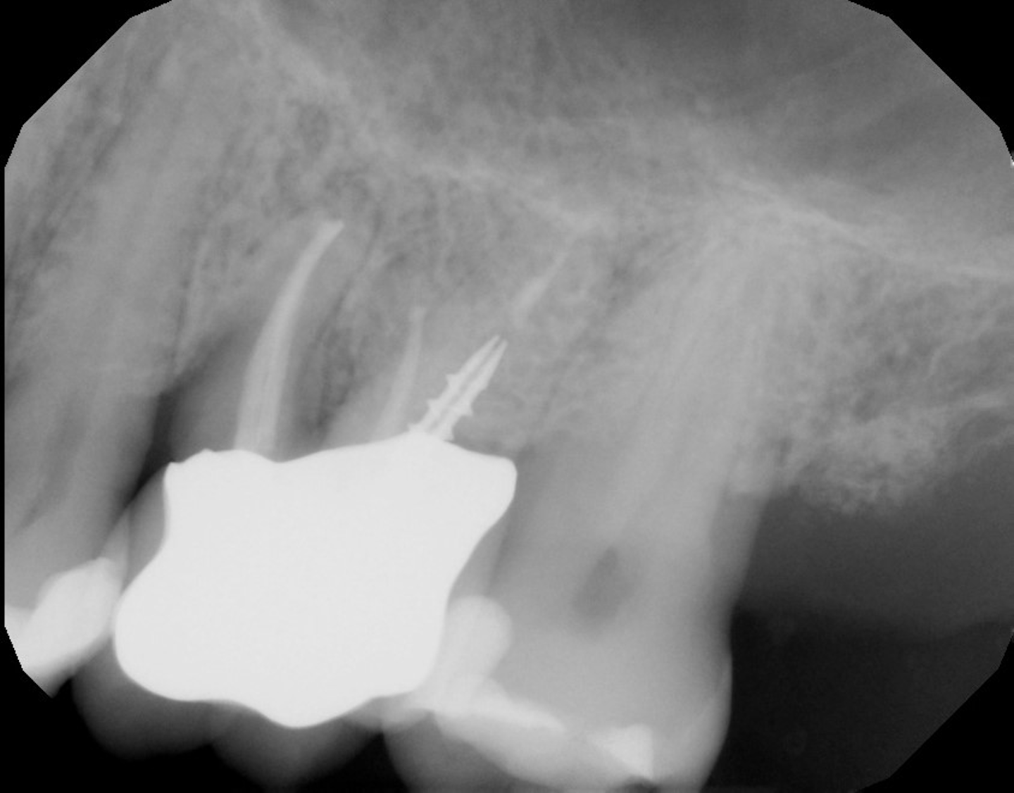 Avoiding dental implants and the sinus lift procedure: Revisiting ...
