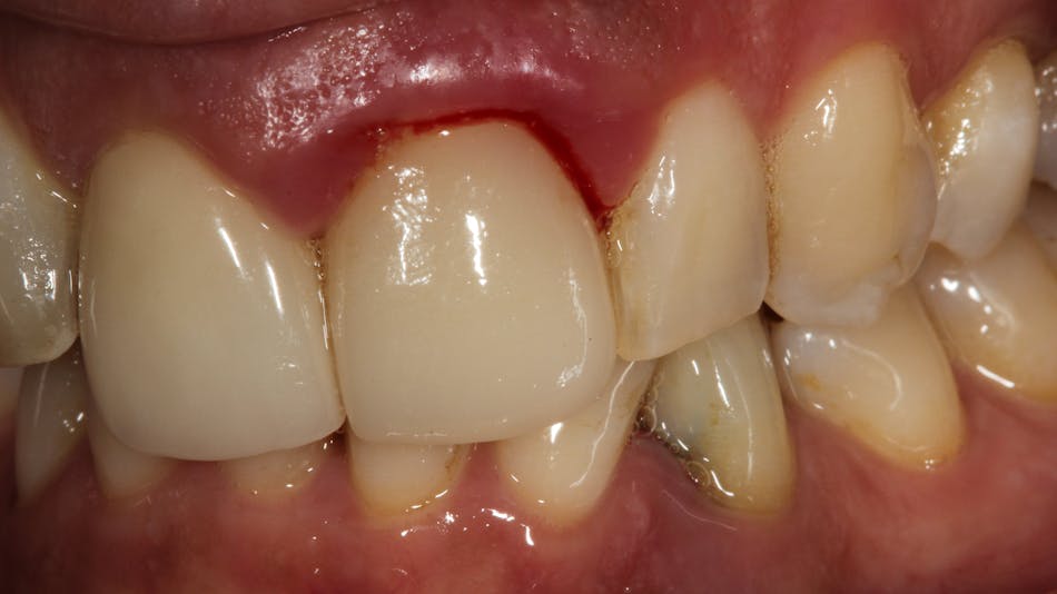 Gum bleeding after a dental cleaning | Perio Implant Advisory