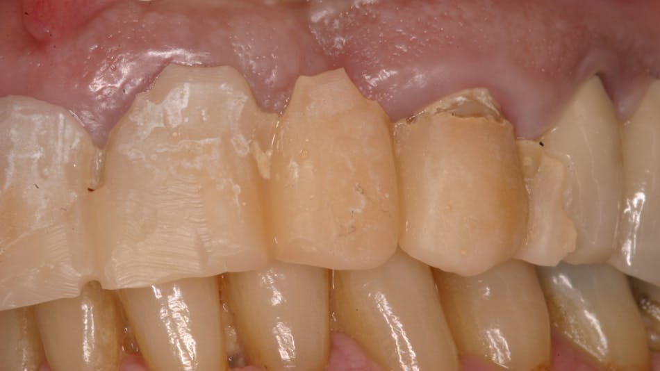 The crown the lab made doesn't fit: Why does this happen? | Perio ...