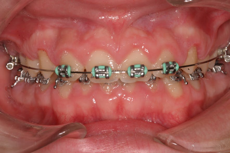 Top causes of gingival enlargement and treatment options | Perio ...