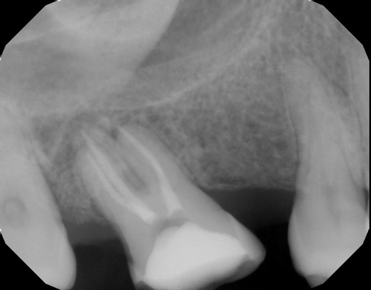 What is a periapical radiolucency? | Perio Implant Advisory