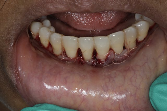 Teeth with bone loss beyond the root apex: Can they be saved? | Perio ...