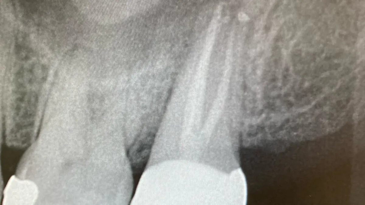 How can you tell if a root is fractured? | Perio Implant Advisory