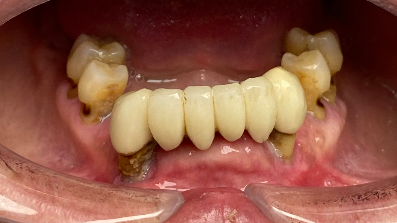 Heroin Effects On Teeth