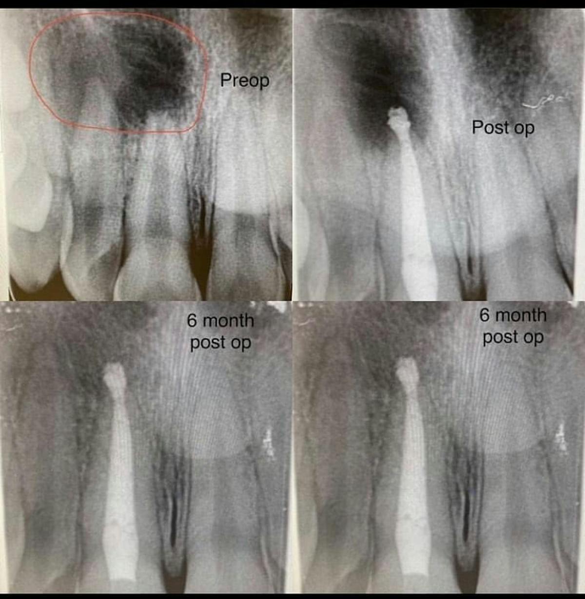 Healing after root canal therapy: When should you get a crown placed ...