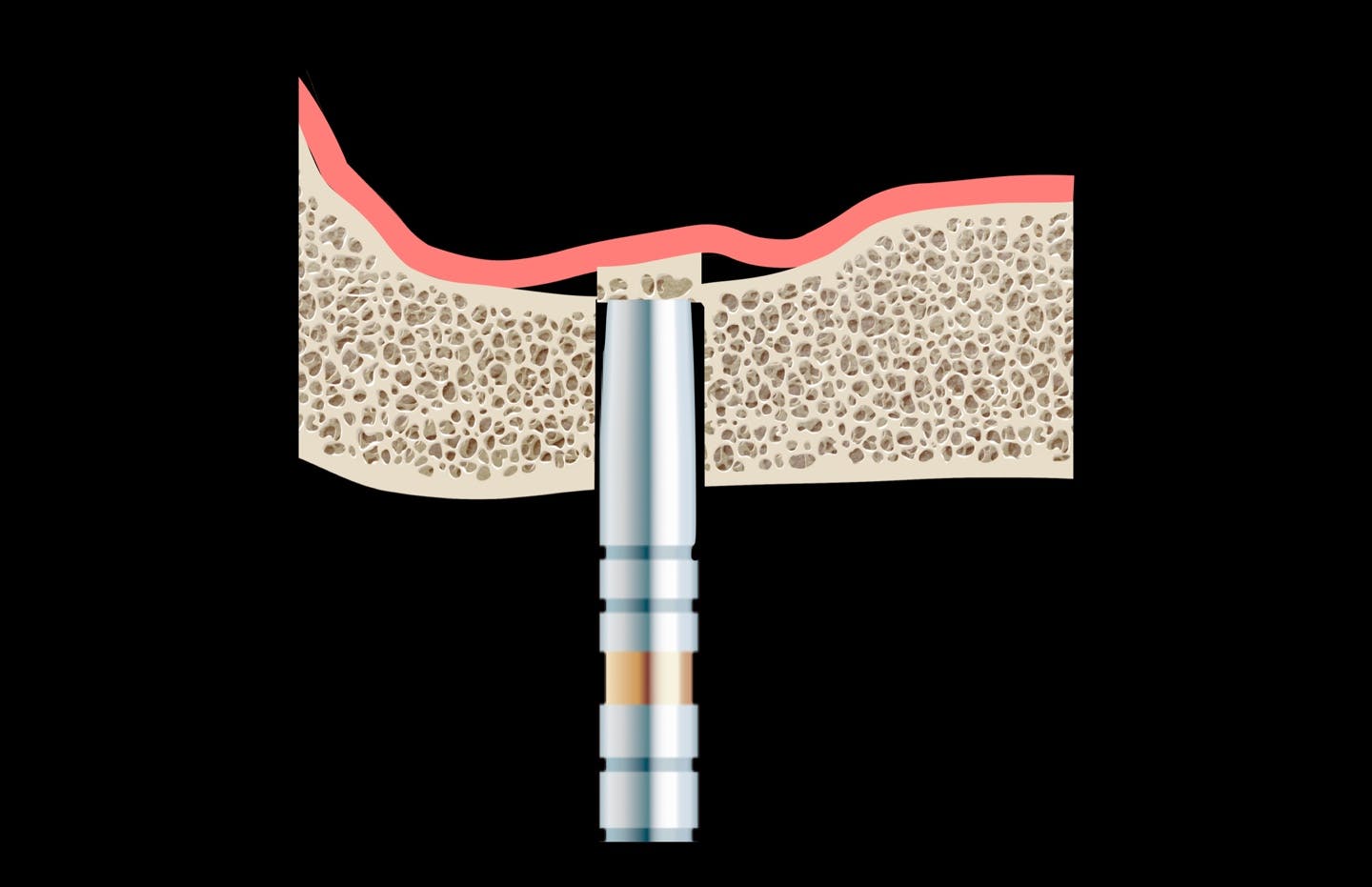 Maxillary Sinus Floor Elevation