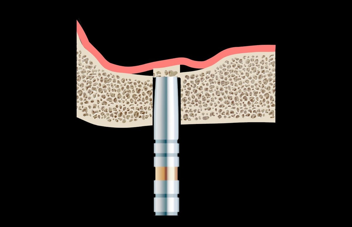 Sinus lifts made safe and easy using hydraulics | Perio Implant Advisory