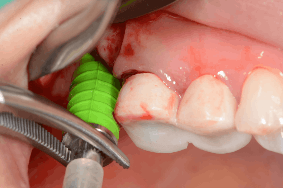 Sinus lifts made safe and easy using hydraulics | Perio Implant Advisory
