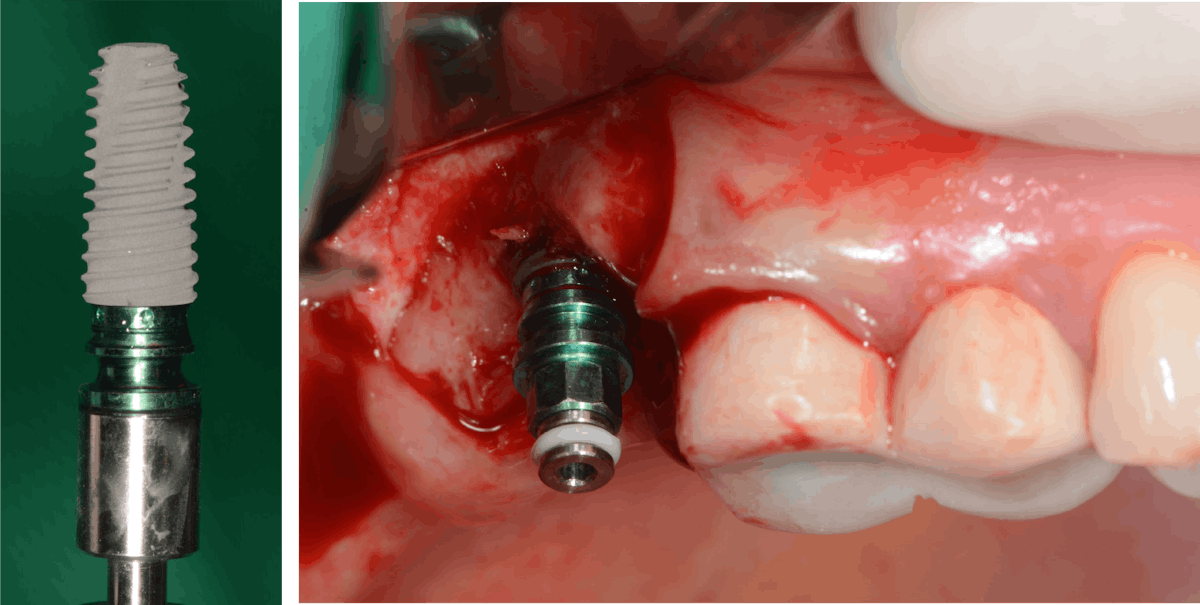 Sinus lifts made safe and easy using hydraulics | Perio Implant Advisory