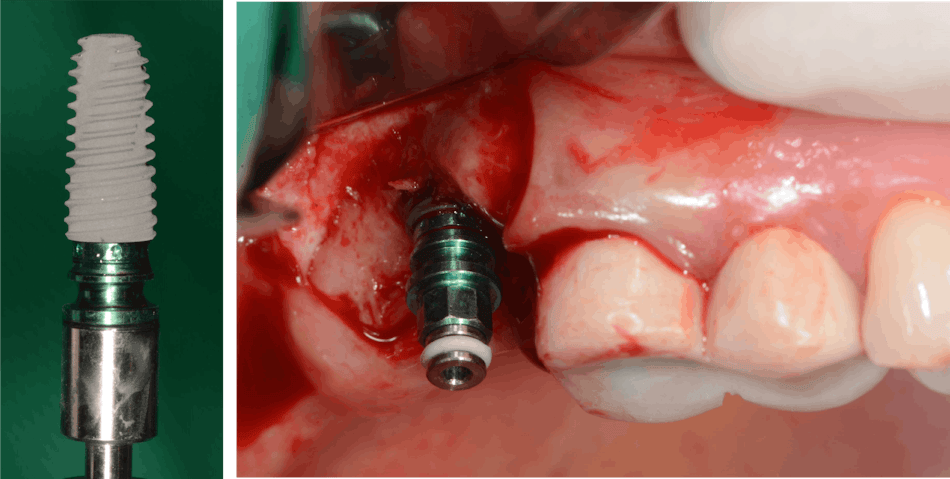 Sinus lifts made safe and easy using hydraulics | Perio Implant Advisory