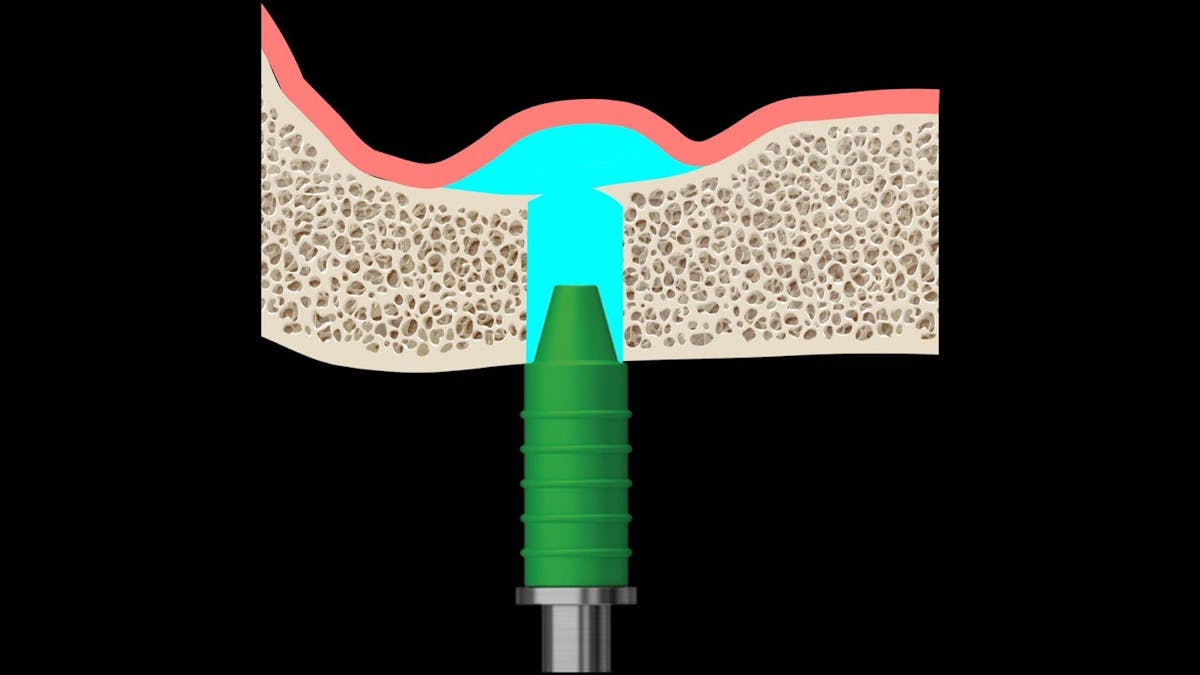 Sinus lifts made safe and easy using hydraulics | Perio Implant Advisory