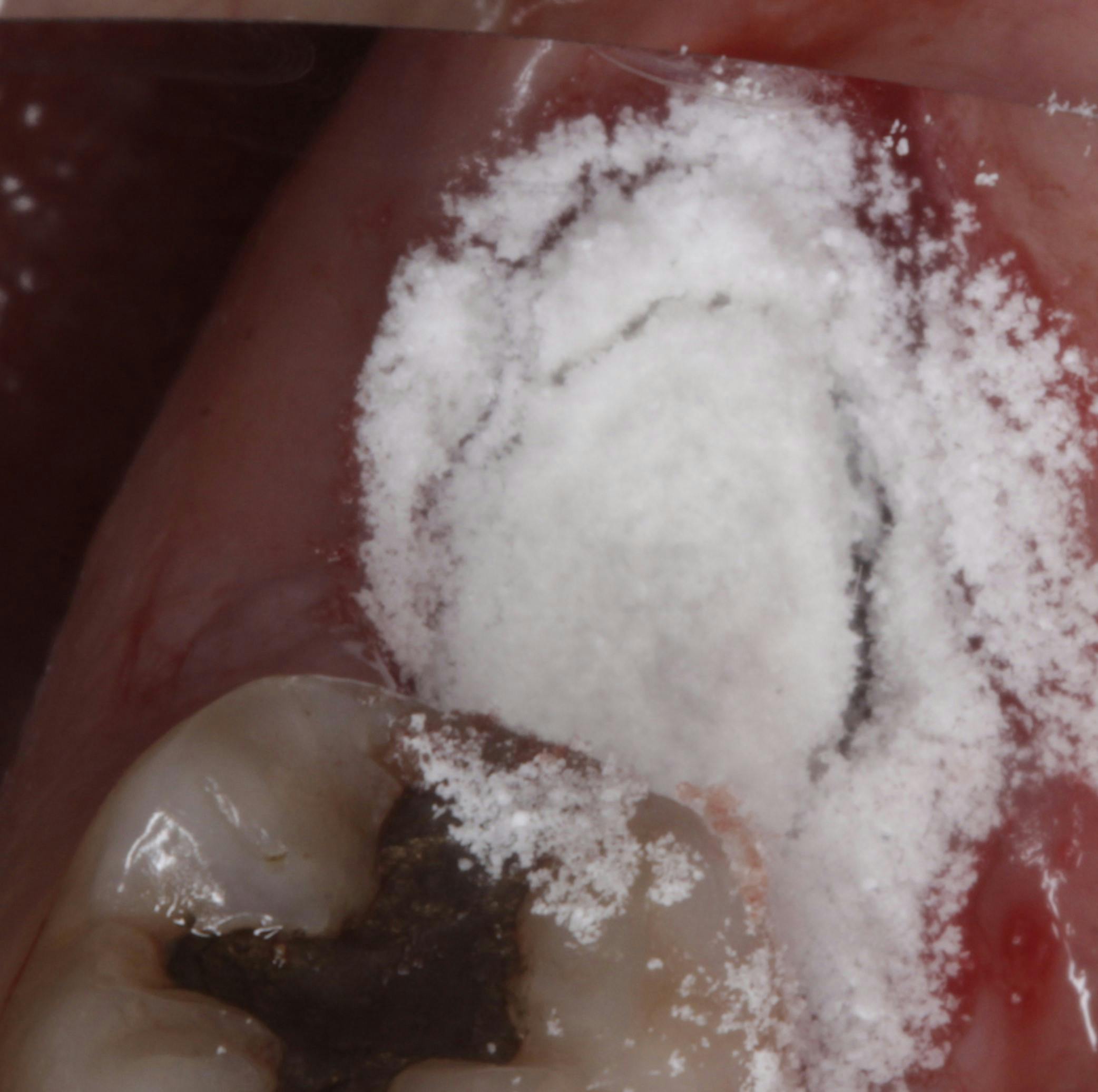 Dry socket prevention with the Polyox bandage | Perio Implant Advisory