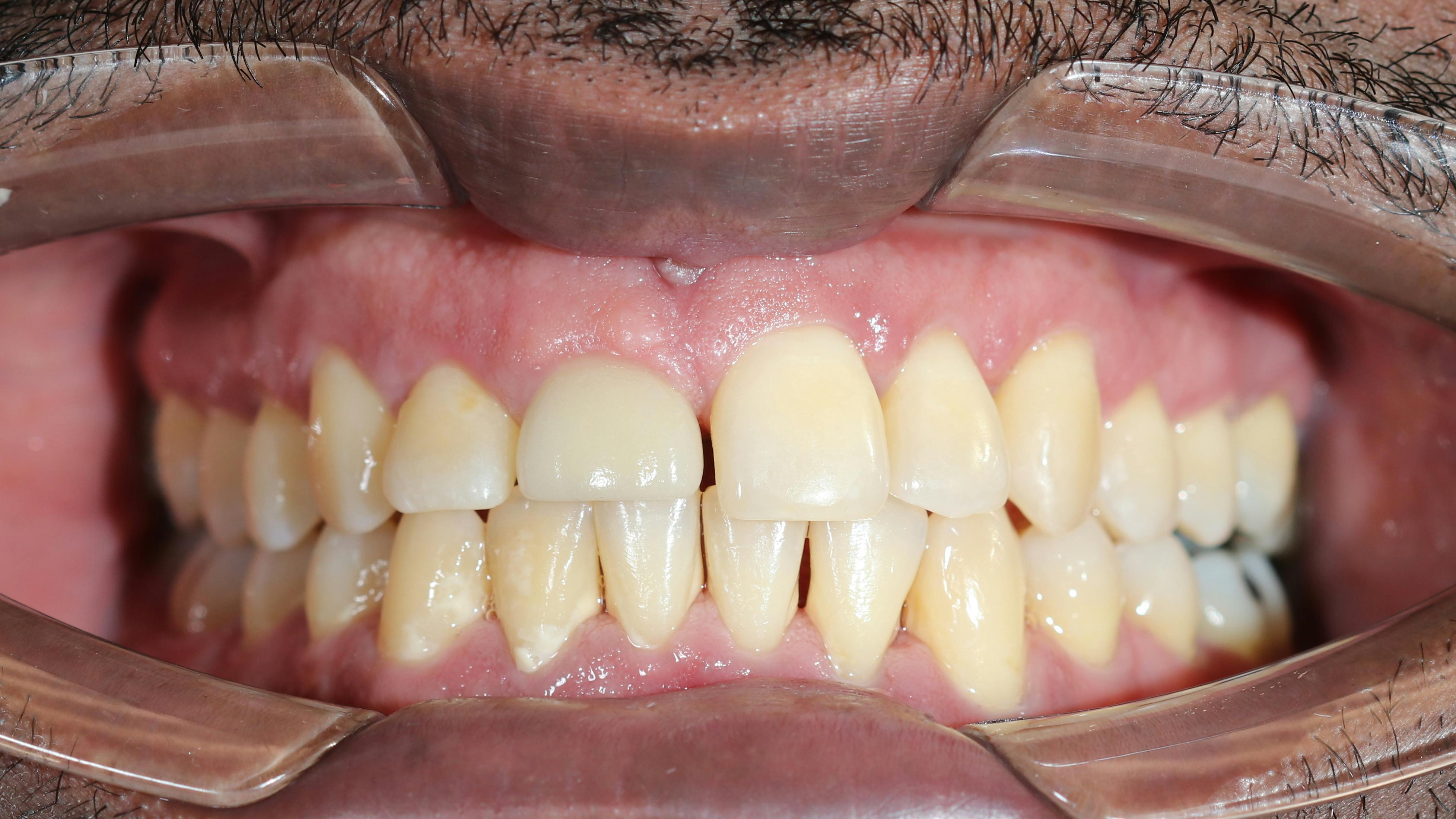 The ideal esthetic dental implant restoration: Will it still look like ...